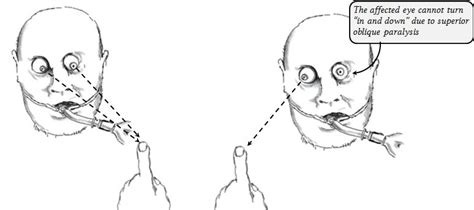 Lesions Of The Trochlear Nerve Cn Iv Deranged Physiology