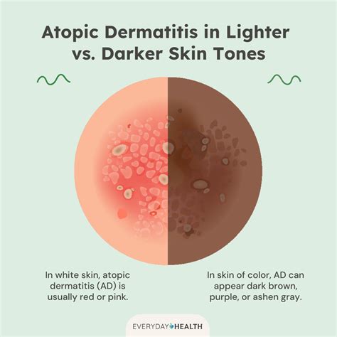 Atopic Dermatitis Symptoms On Darker Skin What To Know