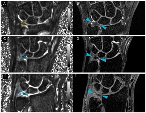 Triangular Fibrocartilage Characterization With Ultrashort Echo Time T2 Mri Insights From A