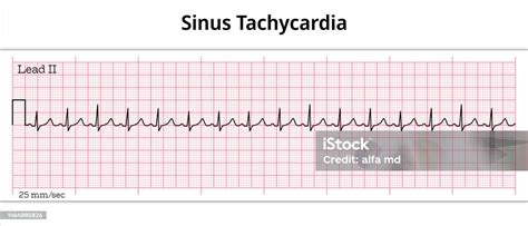 Ecg Sinus Tachycardia 8 Second Electrocardiography Paper Stock