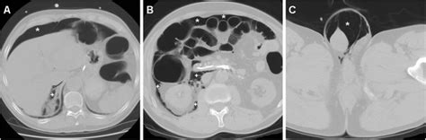 4 Stapfer Type I Dp With Moderate Retroperitoneal Air Plus Download Scientific Diagram