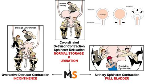 Multiple Sclerosis Research Finding Bladder Problems