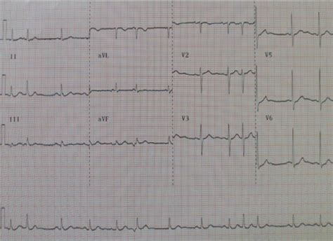 Phimaimedicine Frequency Premature Atrial Contraction PAC