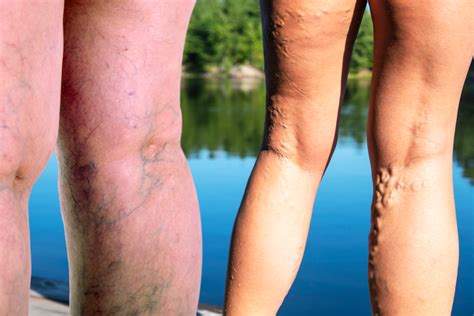 Varicose Veins Throughout History