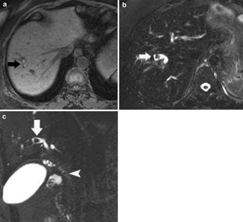 Recurrent Pyogenic Cholangitis Axial T1 Weighted Fat Sat Pre Contrast Download Scientific