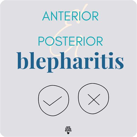 Anterior Vs Posterior Blepharitis Visual Examples And Key Difference We Love Eyes