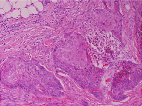 Evidence Of Squamous Differentiation In The Basaloid Island In The Download Scientific Diagram