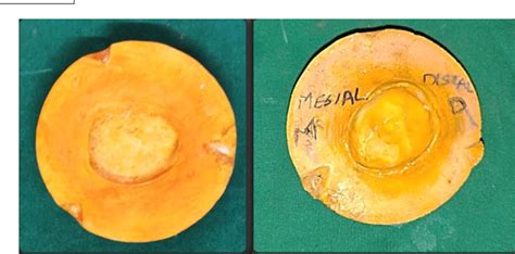 Figure 1 From Prosthetic Rehabilitation Of An Ocular Defect A Case Report Semantic Scholar