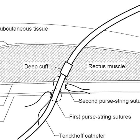 A Schematic Diagram Of Catheterization A Double Purse String Sutures Download Scientific