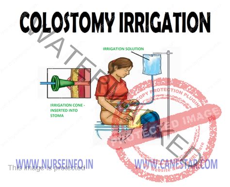 Colostomy Irrigation Nursing Notes Mcqs And Procedures Posttitle