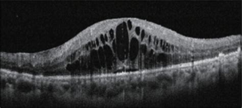 comparison of segmentation performance of macular edema between the download scientific diagram