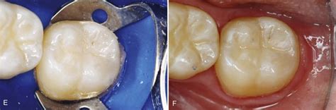 10 Class I Ii And Vi Direct Composite Restorations And Other Tooth Colored Restorations 10 Class I Ii And Vi Direct Composite Restorations And Other Tooth Colored Restorations