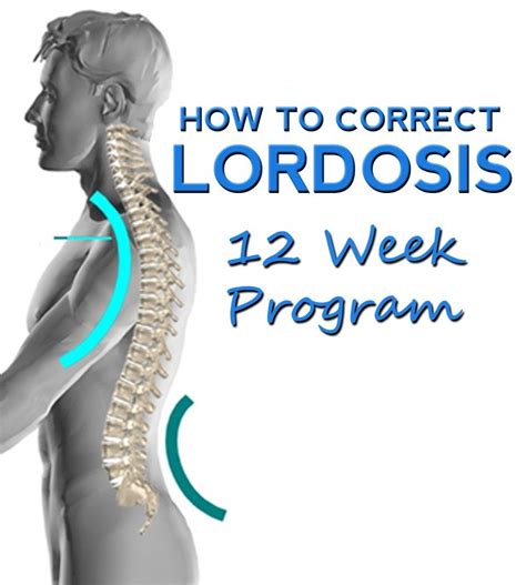 Lordosis Treatment Before After