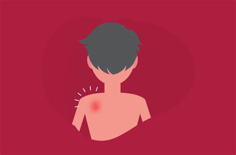 Penyakit Kulit Kronis Kenali 4 Gejala Neurodermatitis