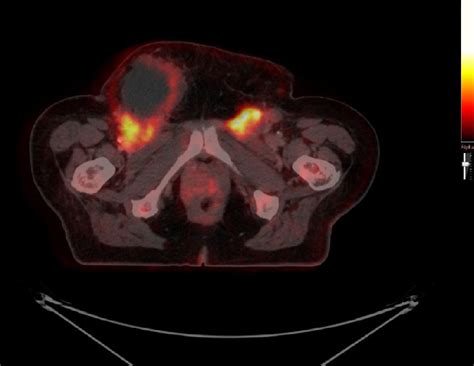 Pdf Ulcerated Inguinal Lymph Node Metastases In Vulvar Cancer Semantic Scholar