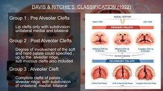 Comprehensive Management Of Cleft Lip And Palate Diagnosis Treatment
