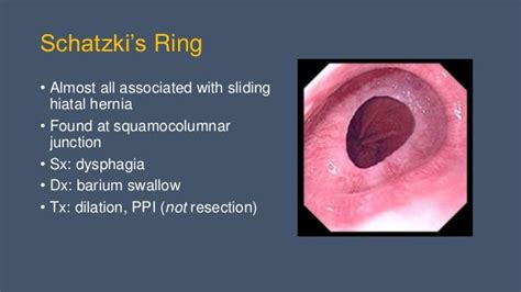 Absite Esophagus