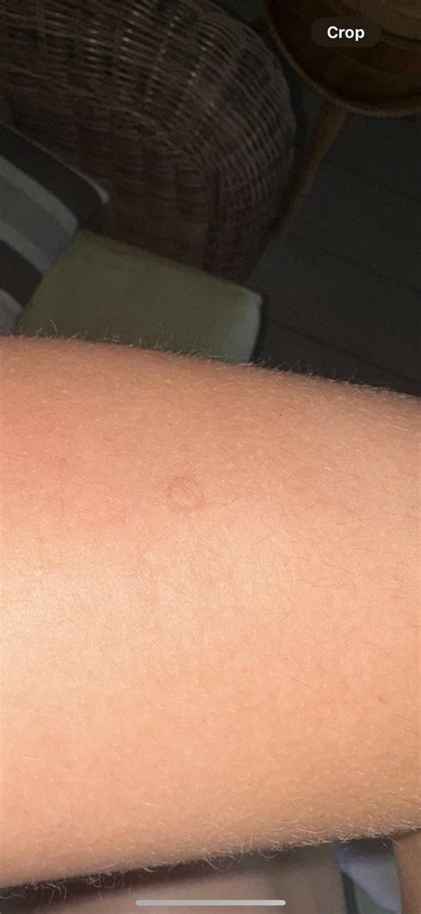Skin Help I Have A Weird Scar That Started Out As Two Small Scabs U