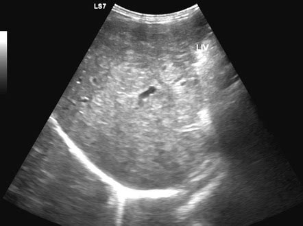 Cholangitis Ultrasound