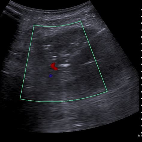 After Injection Of Thrombin Into Pseudoaneurysm Ultrasound