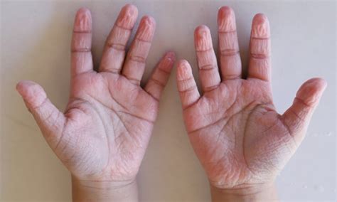 นิ้วเปื่อย Pruney Fingers Hello Khunmor