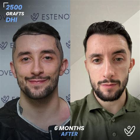 Diffuse Thinning Causes Symptoms And Treatment Options Estenove