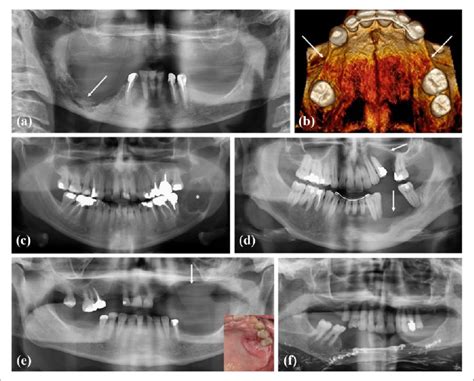 Various Origins Of Bone Defects A Panoramic X Ray Bone Defect Of Download Scientific