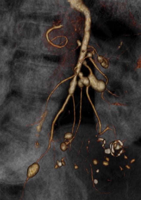 Cta And Mra In Mesenteric Ischemia Part 1 Role In Diagnosis And Differential Diagnosis Ajr