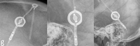 Progav 1 0 Shuntsystem Ars Neurochirurgica