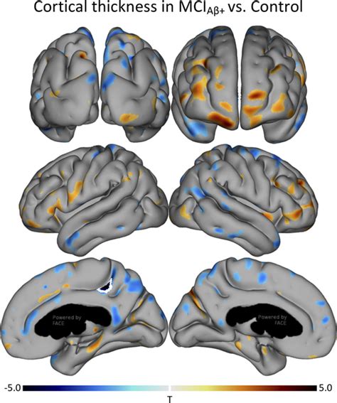 Cortical Thickness In Amyloid Positive Aβ Subjects With Mild Download Scientific Diagram