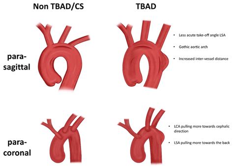 Schematic Overview Of The Spatial Geometric Differences In The Aortic