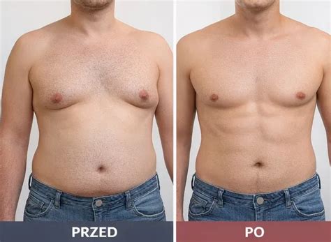 Symmastia „zlanie” Piersi Jak Wygląda Korekta Przy Wymianie