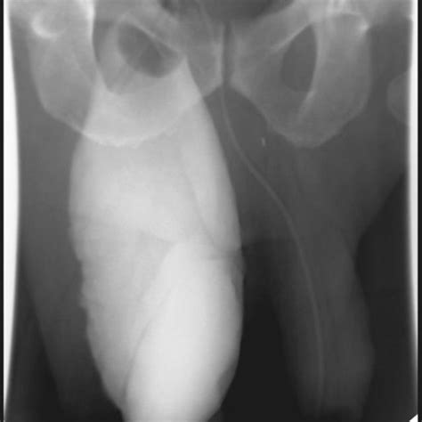 Retrograde Cystogram Showing Bladder Herniation In A 71 Year Old Man