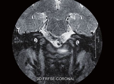 Mri Showing Bilateral Normal Fluid Filled Cochlea The Comma Sign