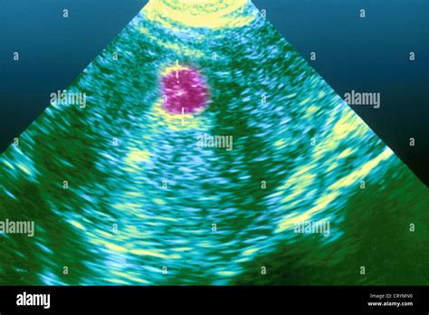 Fibrome utérin Banque de photographies et dimages à haute résolution Alamy