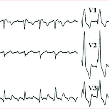 PDF Atrial Flutter An Update