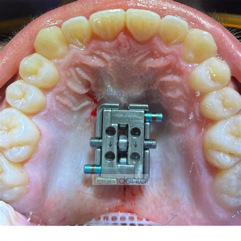 Facegenics Midface Expander Fme Complete Review And Guide