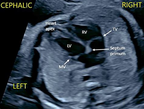 Atrioventricular Septal Defect An Extended Approach To Prenatal