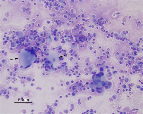 Pyogranulomatous Inflammation Archives Eclinpath