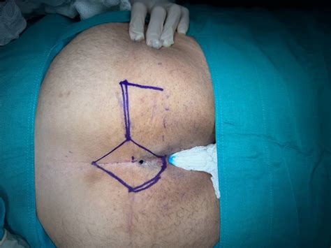 Quiste Pilonidal Dr Fernando Rodríguez