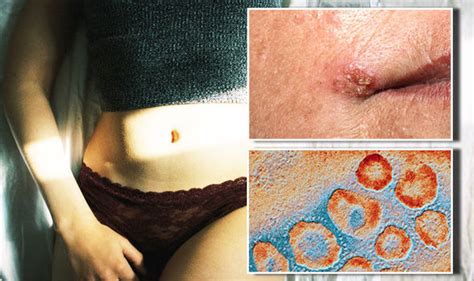 Herpes Sexually Transmitted Virus Is Incurable And Can Cause Painful Blisters Express Co Uk