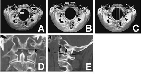 Measurements Of The Occipital Condyle A Length B Width C Axial Download Scientific