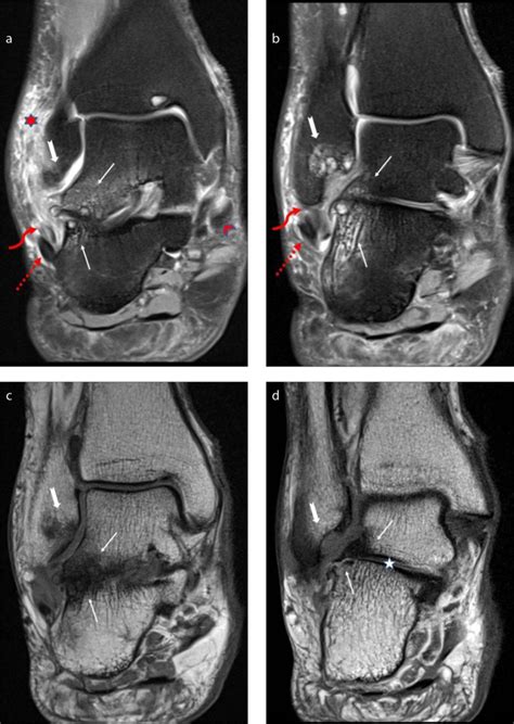 Mri Of Lateral Hindfoot Impingement Pmc