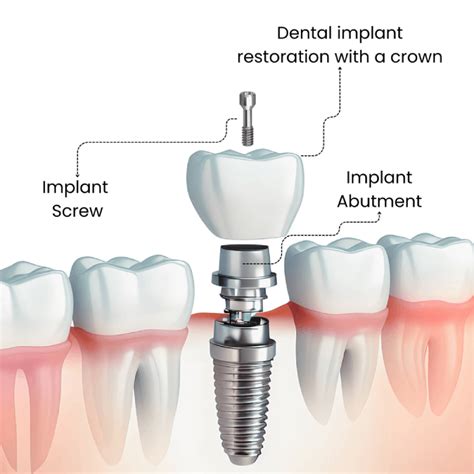 Comprehensive Guide Dental Implant Components And Uses