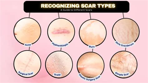 5 Common Scar Types And How To Treat Them