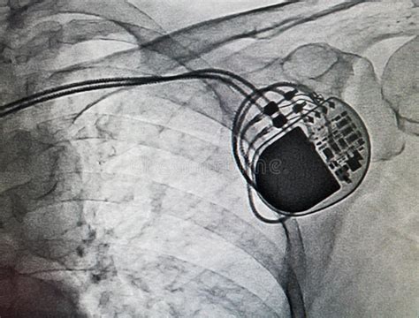 Dddr Pacemaker Arkivfoto Bild Av Diagnostisera Sjukdom 74100186