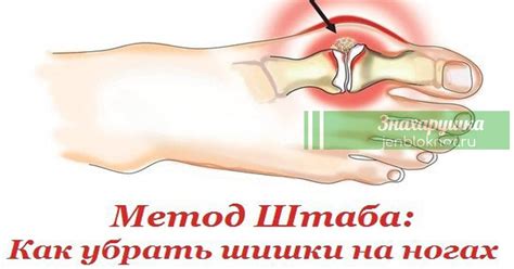 Вот это да Эффективный метод Н Н Штаба избавит от болезненной шишки на ноге Знахарушка все