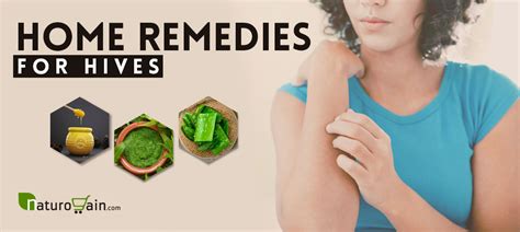 8 Best Home Remedies For Hives To Relieve Itching