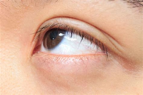 눈다래끼 전염되나요 원인·치료법·빨리 낫는 법 총정리 닥터나우