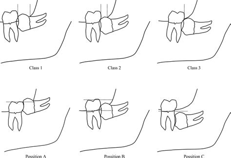 Classification System Of Impacted Mandibular 3rd Molar Pell 46 Off